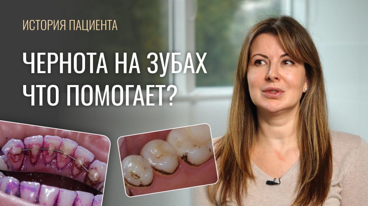 ЧЕРНОТА НА ЗУБАХ, ЧТО ПОМОГАЕТ? История пациента.