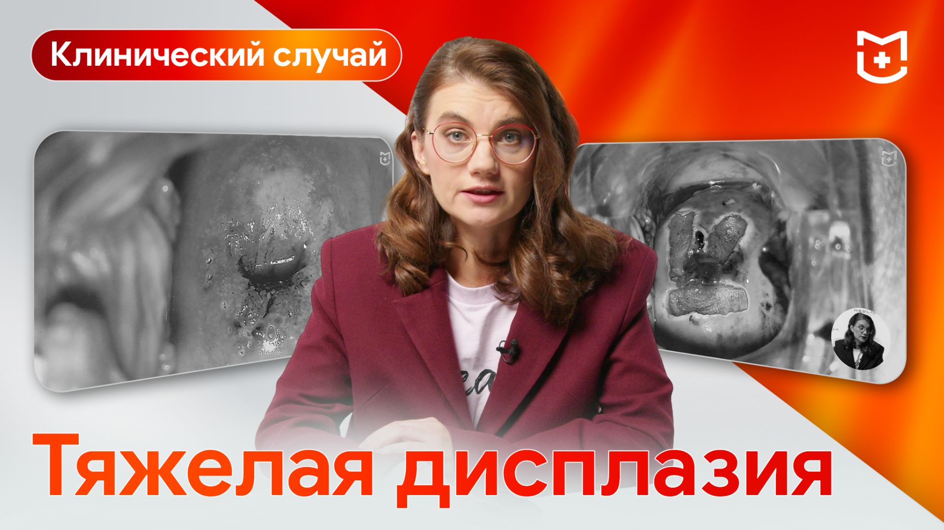 Тяжелая дисплазия шейки матки: клинический случай кольпоскопии и биопсии