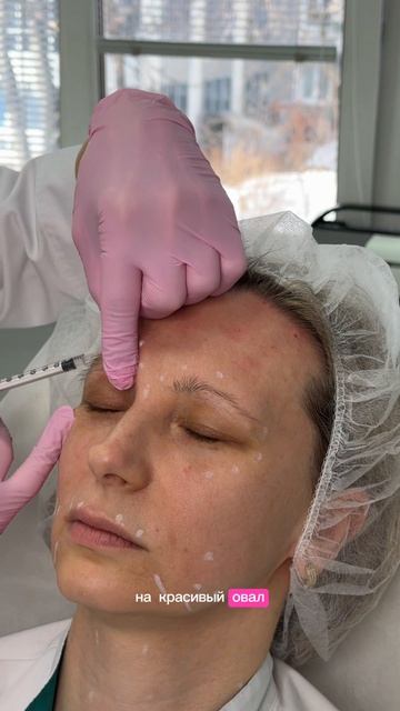 Ботулинотерапия full face