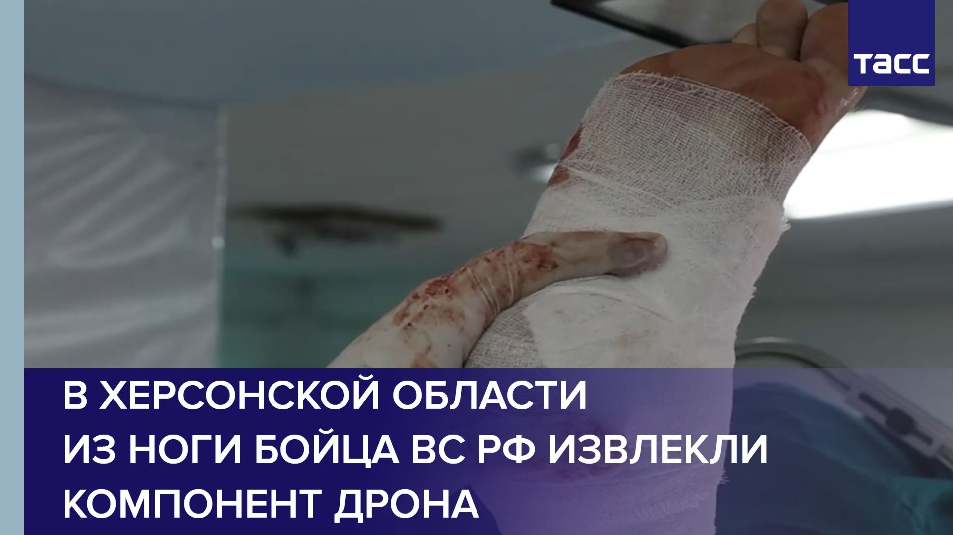 В Херсонской области из ноги бойца ВС РФ извлекли компонент дрона