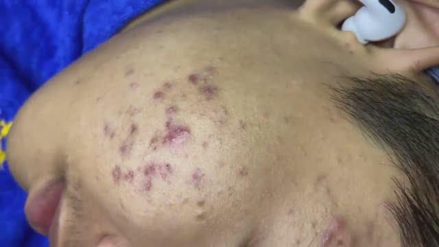 034 • Relax Spa • АСМР • Acne collection