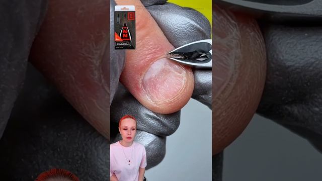 Налипшая кутикула, сильные заусенцы, трещины на ногтевой пластине и она  признает, что  ковыряет 😔