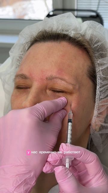 Почему ботулинотерапия full face — лучший выбор?