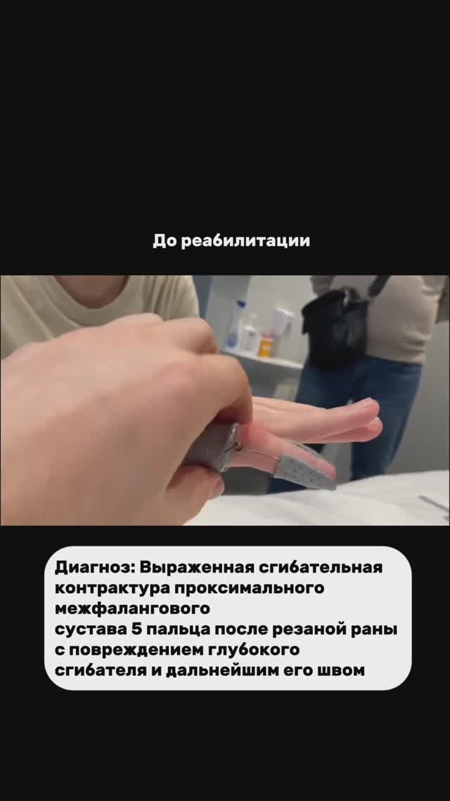 🩺 Клинический случай: реабилитация пациента с контрактурой после повреждения сухожилия сгибателя