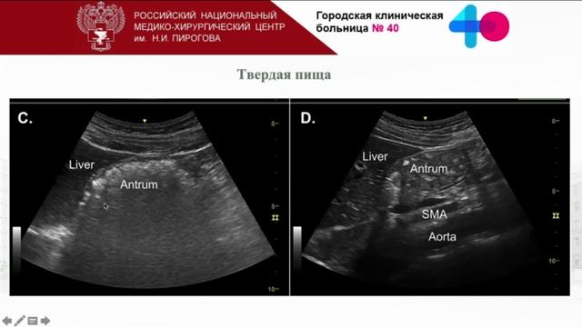 УЗИ желудка Щепарев И.С.