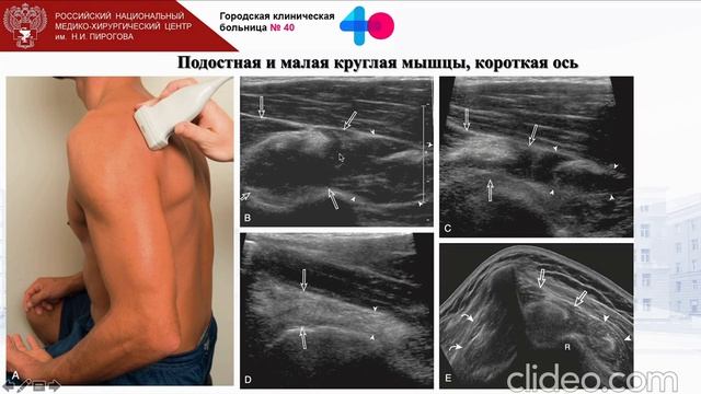 УЗИ плеча часть 2 Щепарев И.С.