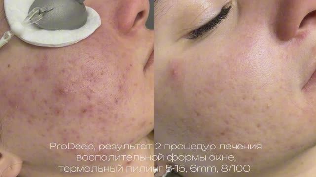 Процедуры на Vydence До и После в России 2025 (Вайденс - Виденс До и После в России 2025).