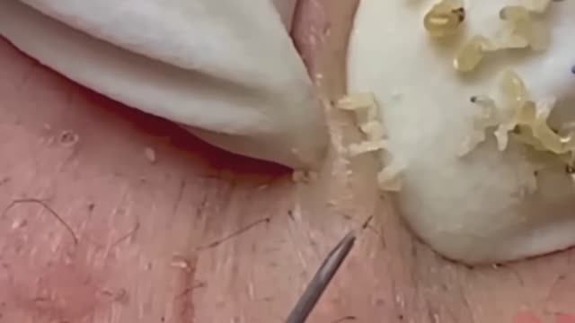 #201 Чистка лица от угрей и акне. Выдавливание прыщей. Удаление черных точек и комедонов