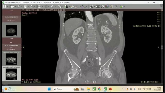 Эндолики при эндоваскулярном протезировании аневризмы брюшной аорты на примере клинических случаев