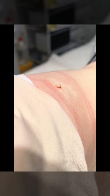 Как проходит удаление папилломы