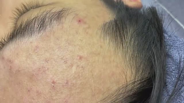 039 • Relax Spa • АСМР • Acne collection