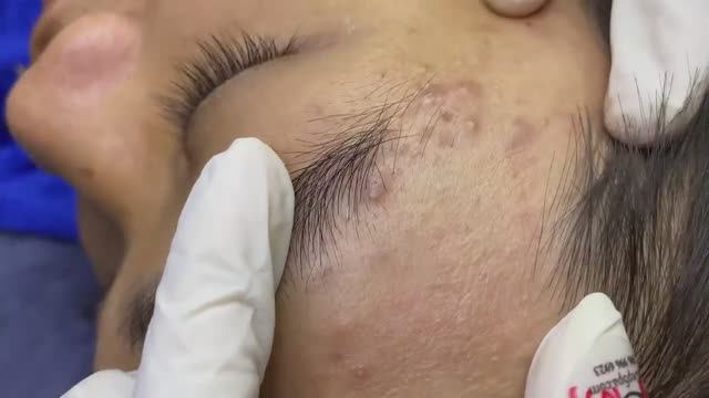 036 • Relax Spa • АСМР • Acne collection