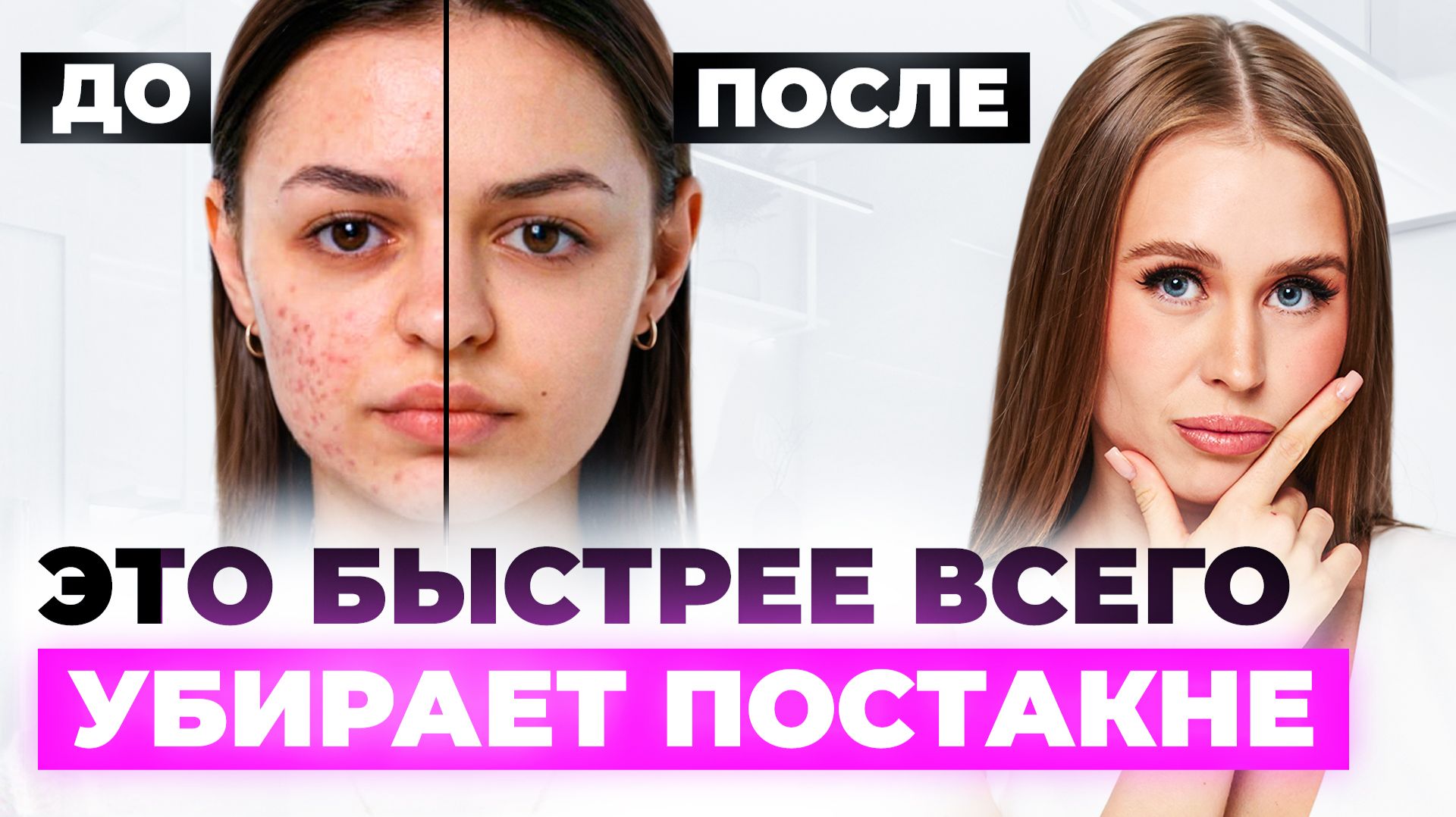 Изменили в уходе ЭТО и ПОСТАКНЕ УШЛО! Пошаговый план как убрать рубцы и высыпания дома