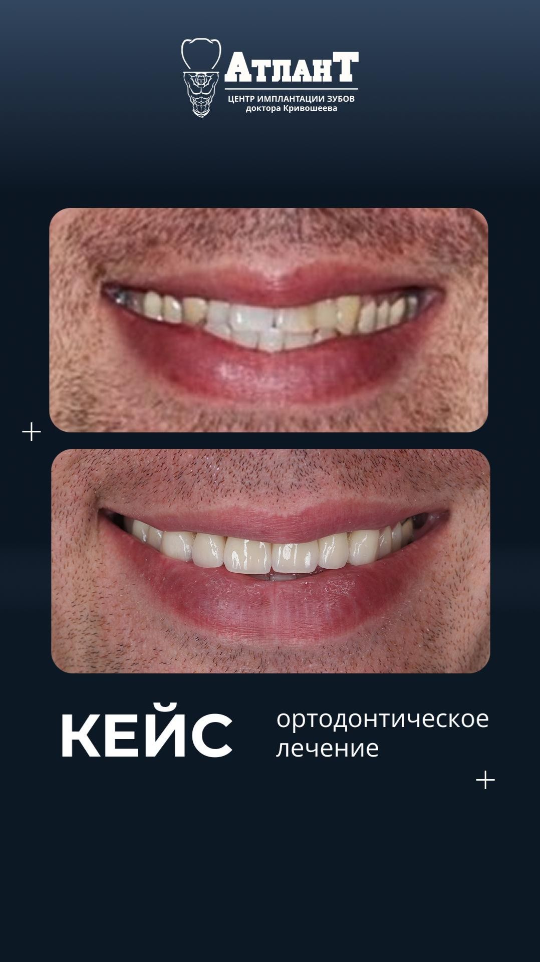 Исправление сложной зубо-челюстной аномалии (ортодонтия, гнатохирургия и протезирование) #shorts