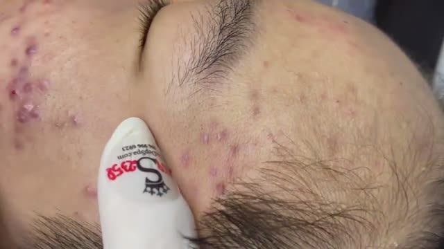 038 • Relax Spa • АСМР • Acne collection