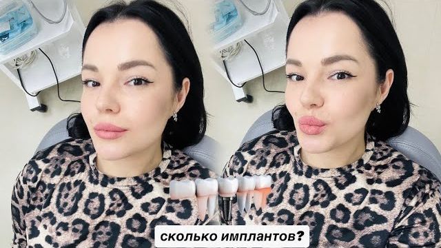 ИМПЛАНТАЦИЯ ЗУБОВ | моя история, отёк и боль