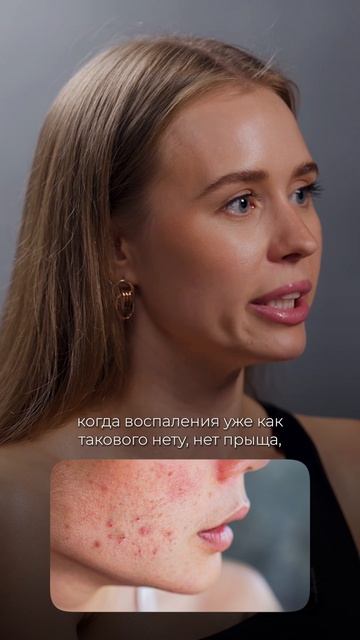 Вот почему постакне так долго проходит