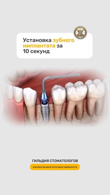 Сколько времени занимает имплантация одного зуба?
