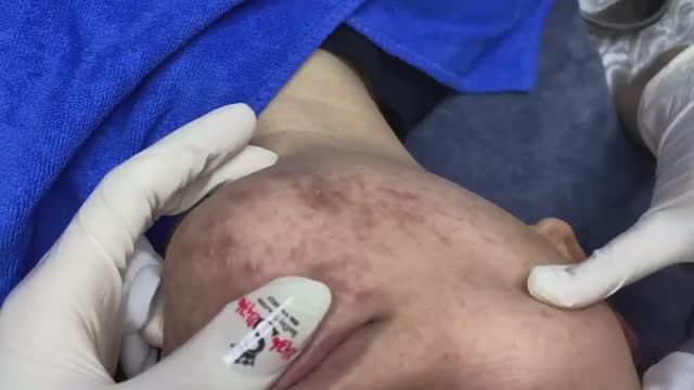 035 • Relax Spa • АСМР • Acne collection