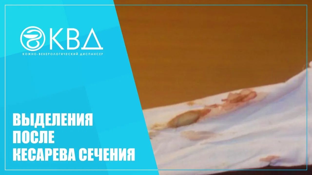 👩 1473  Выделения после кесарева сечения