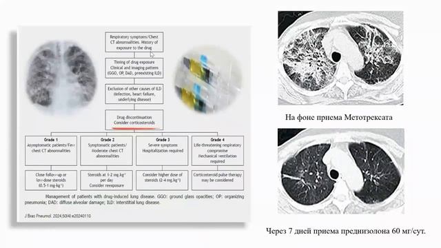 Иммуносупрессивная терапия и туберкулез, актуальные аспекты