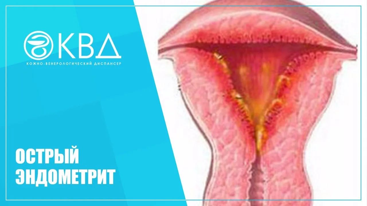 👩 1484  Острый эндометрит