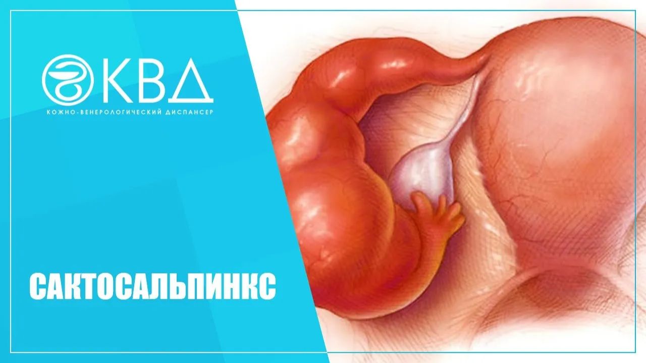 👩 1490  Сактосальпинкс