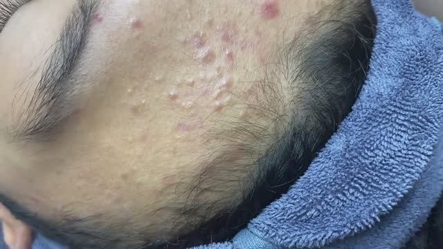 044 • Relax Spa • АСМР • Acne collection