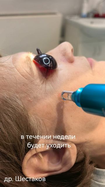 Как удаляют пигментные пятна