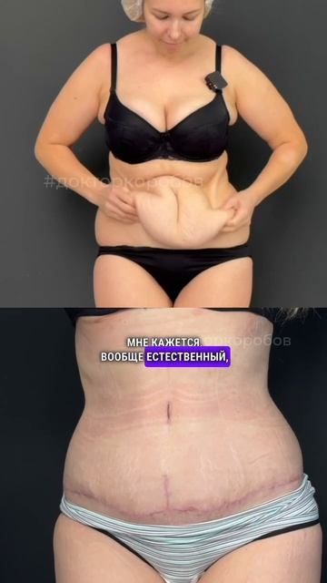 Результаты нижнего бодилифта и липосакции через 3 месяца после операции 🔥