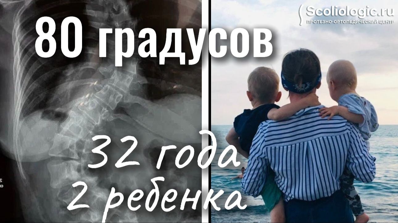 Сколиоз 80 градусов: жизнь и два материнства