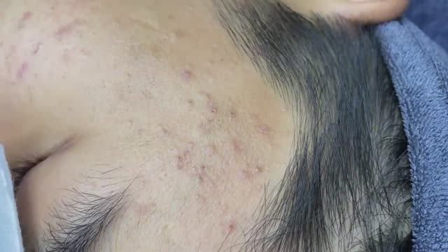 045 • Acne collection • АСМР • Relax Spa