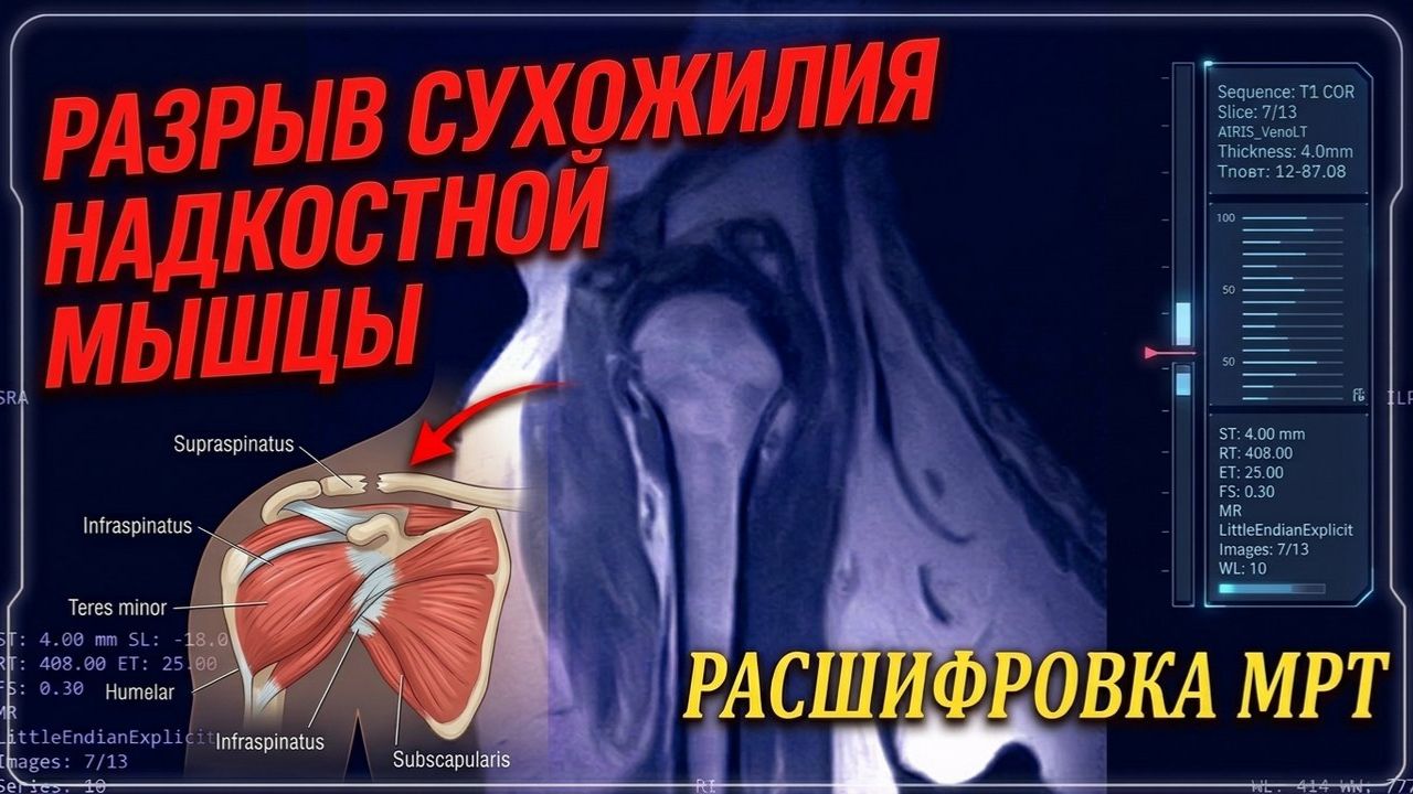 БОЛЬ В ПЛЕЧЕ при разрыве сухожилия, АРТРОЗО-АРТРИТЕ, разрыве суставной губы на РАСШИФРОВКЕ МРТ плеча
