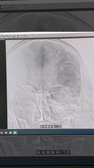 Врачи БСМП спасли пациентку с лопнувшим сосудом мозга