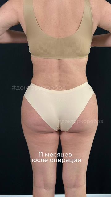 Результат через 11 месяцев 🔥 Талия и формы после комплексной операции