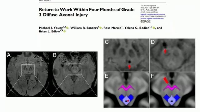 Comatose patient ISICEM 45