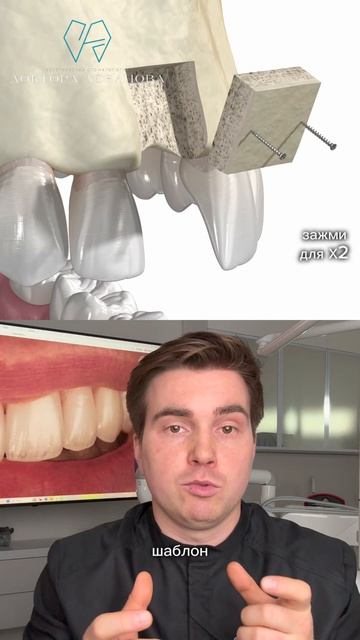 В нашей клинике мы в егда рекомендуем ставить имплантат, а не ждать, когда атрофируется кость