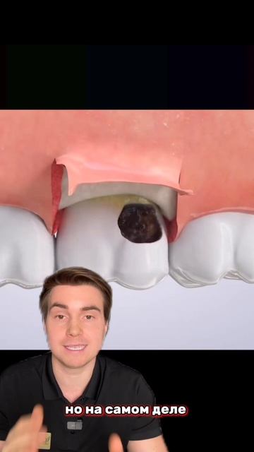 Не удаляйте зуб, который разрушен под десну