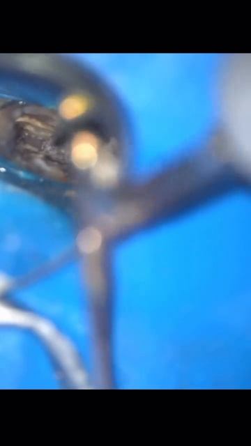 Сложный зуб с штифтами и отломком инструмента — результат через год