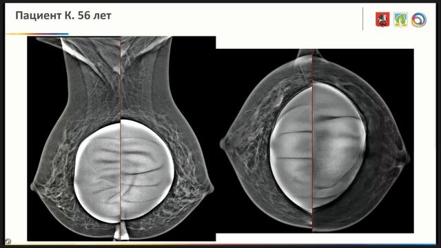 Разбор сложных и интересных случаев по модальности Маммография Март 2026 года