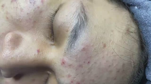 051 • Acne collection • АСМР • Relax Spa