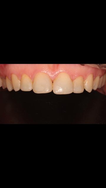 Фронтальная реставрация зубов: работа с формой и цветом