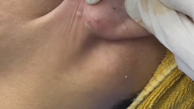 052 • Acne collection • АСМР • Relax Spa