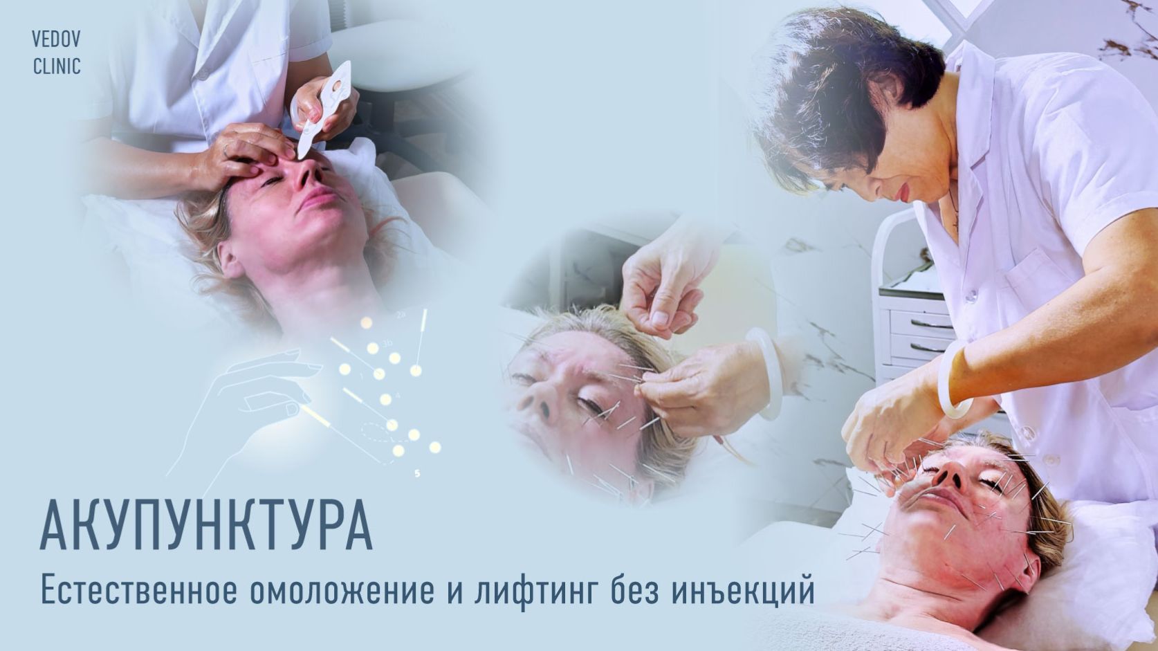 Акупунктурный лифтинг лица в клинике Доктора Ведова
