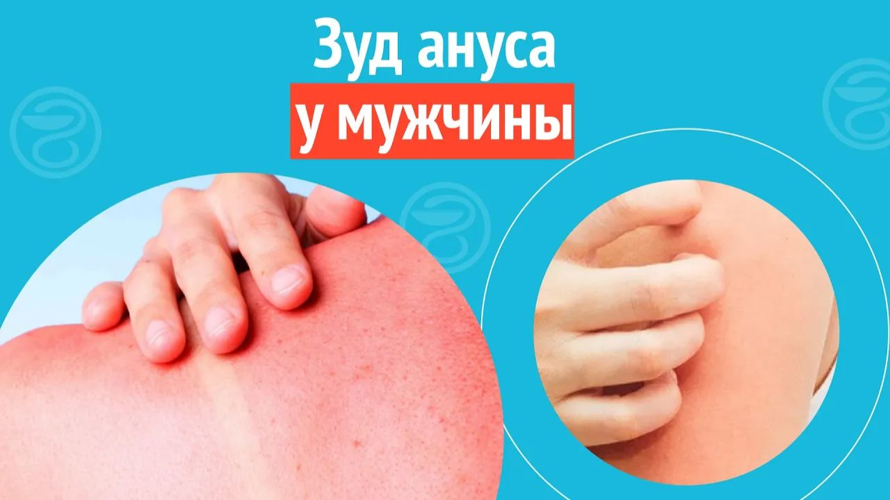 😟 Зуд ануса у мужчины. Клинический случай №1306