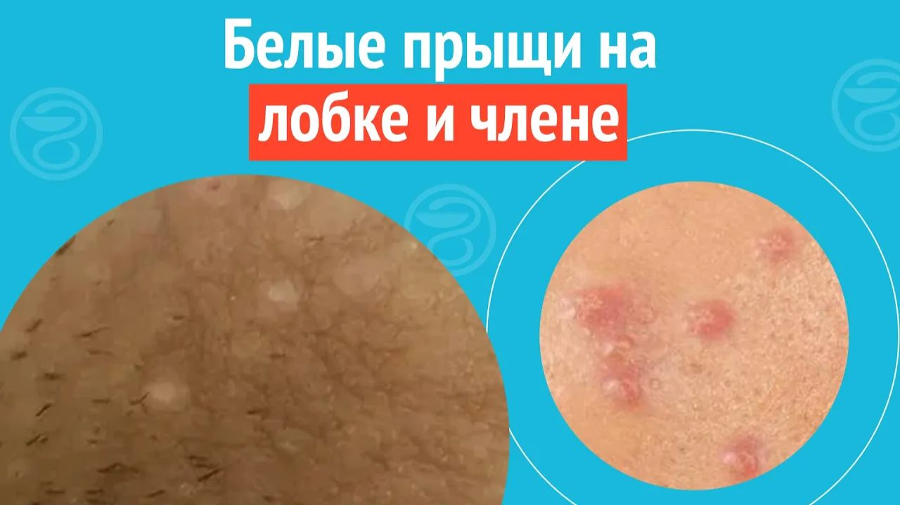 ⏯️ Белые прыщи на лобке и члене. Клинический случай №1308
