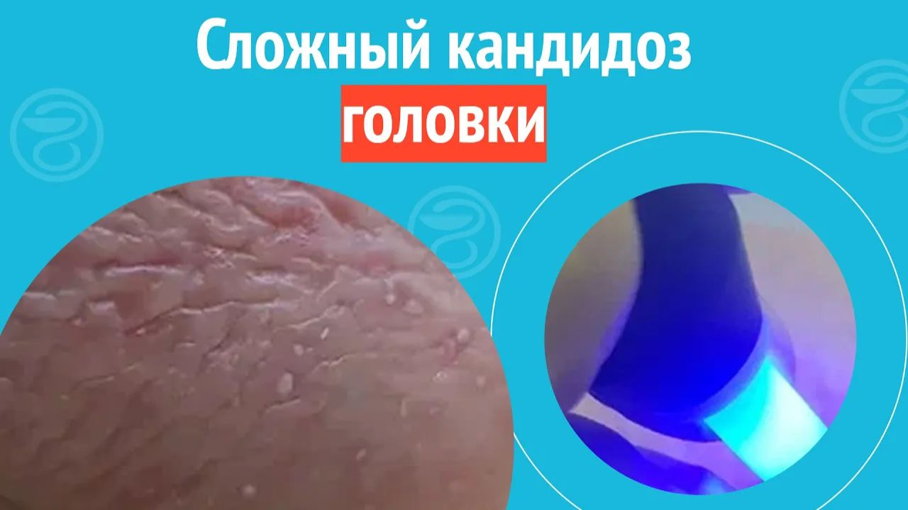 😕 Сложный кандидоз головки. Клинический случай №1302
