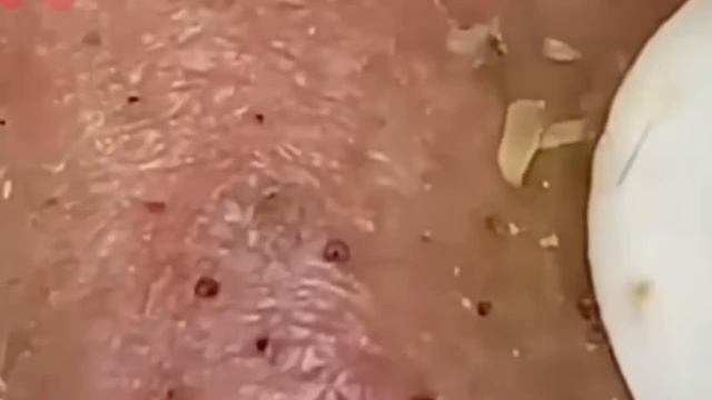 #227 Чистка лица от угрей и акне. Выдавливание прыщей. Удаление черных точек и комедонов