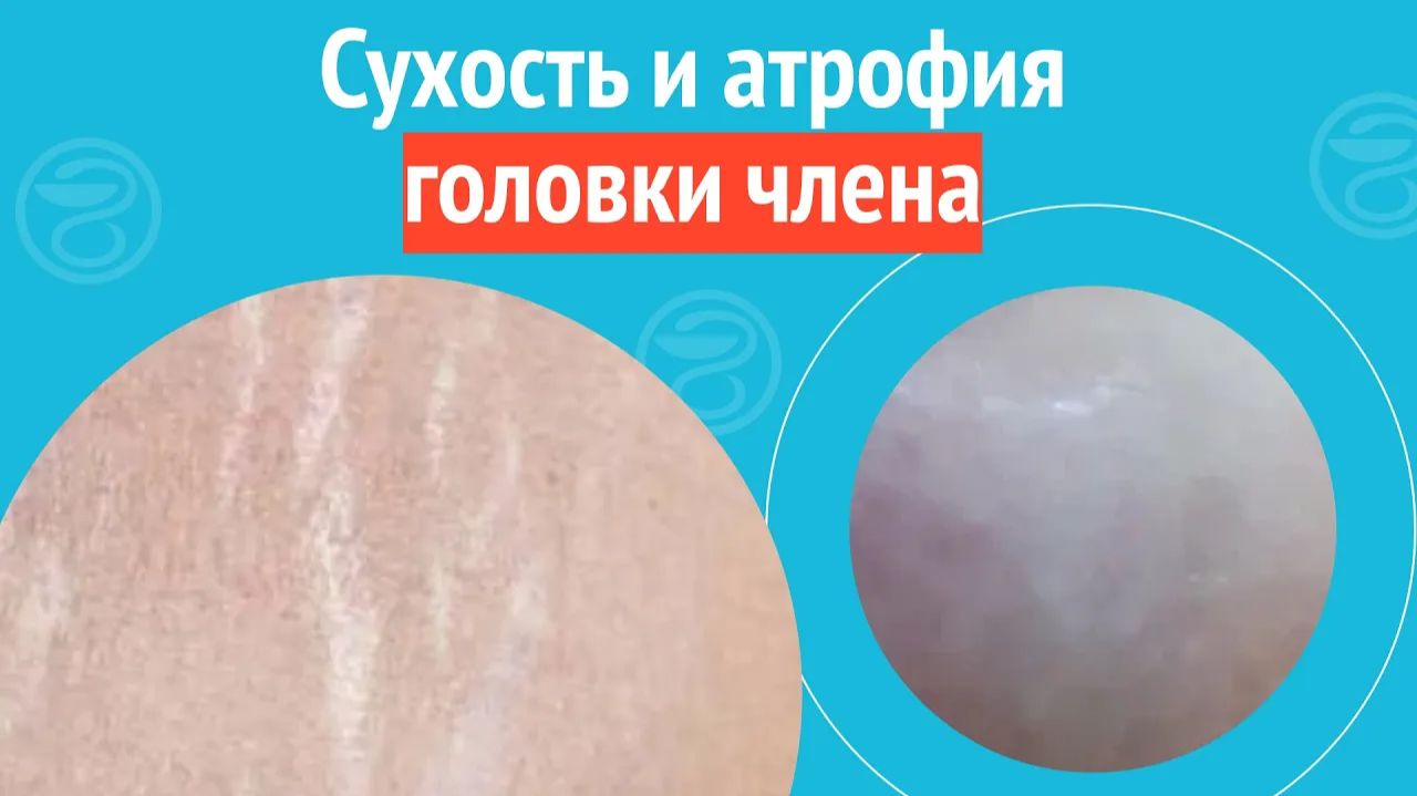 🤨 Сухость и атрофия головки члена. Клинический случай №1305