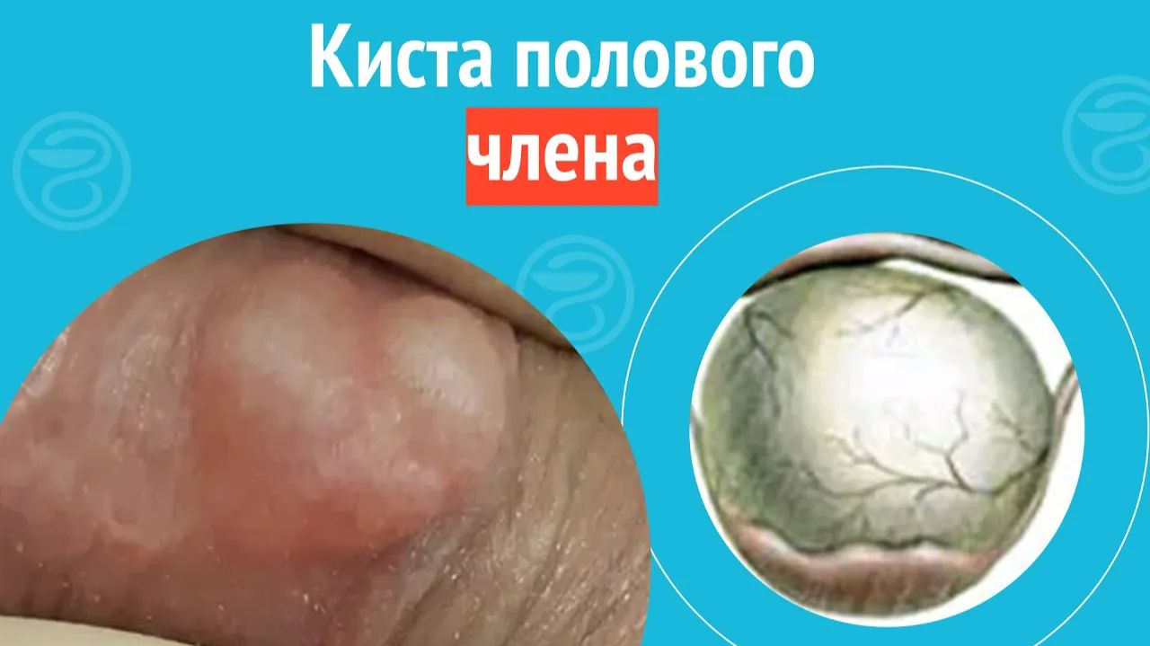 👉 Киста полового члена. Клинический случай №1304